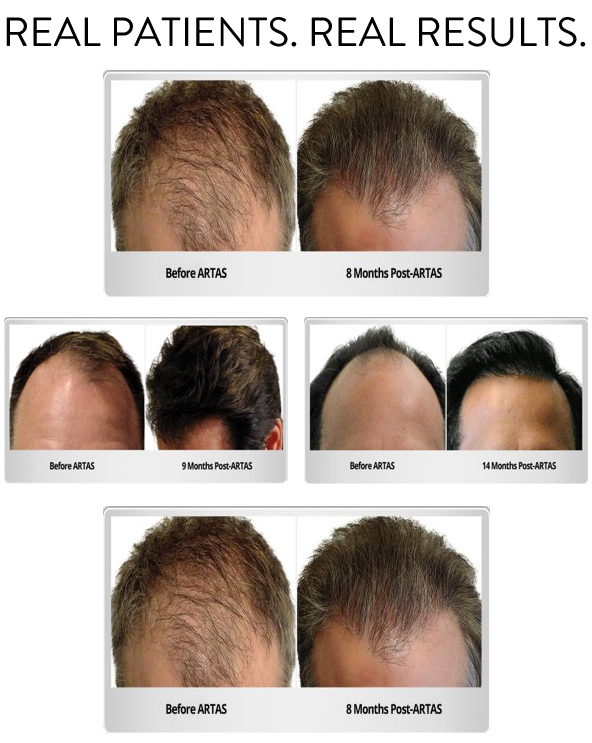 ARTAS Robotic Hair Transplant - Best Hair Restoration and Transplant in ...